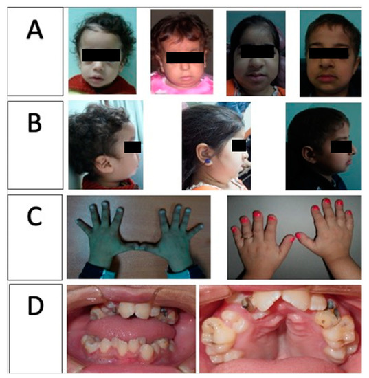 Genetic and Molecular Evaluation: Reporting Three Novel Mutations and ...