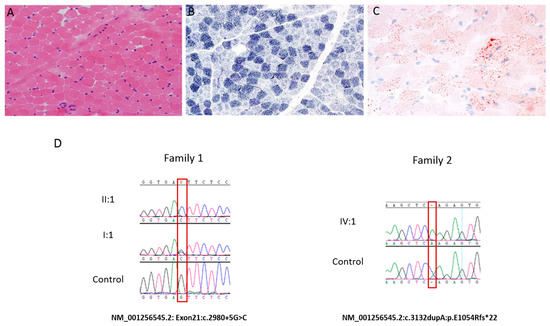 Genes | Free Full-Text | Phenotypic Variability of MEGF10 Variants ...