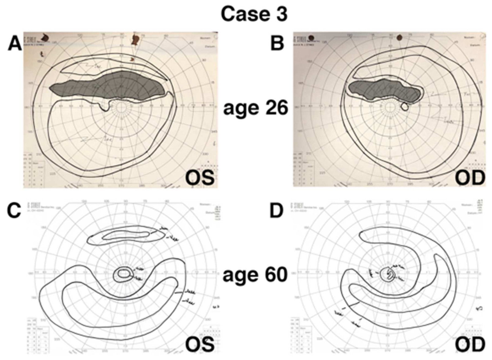 Beyond Sector Retinitis Pigmentosa: Expanding the Phenotype and Natural ...