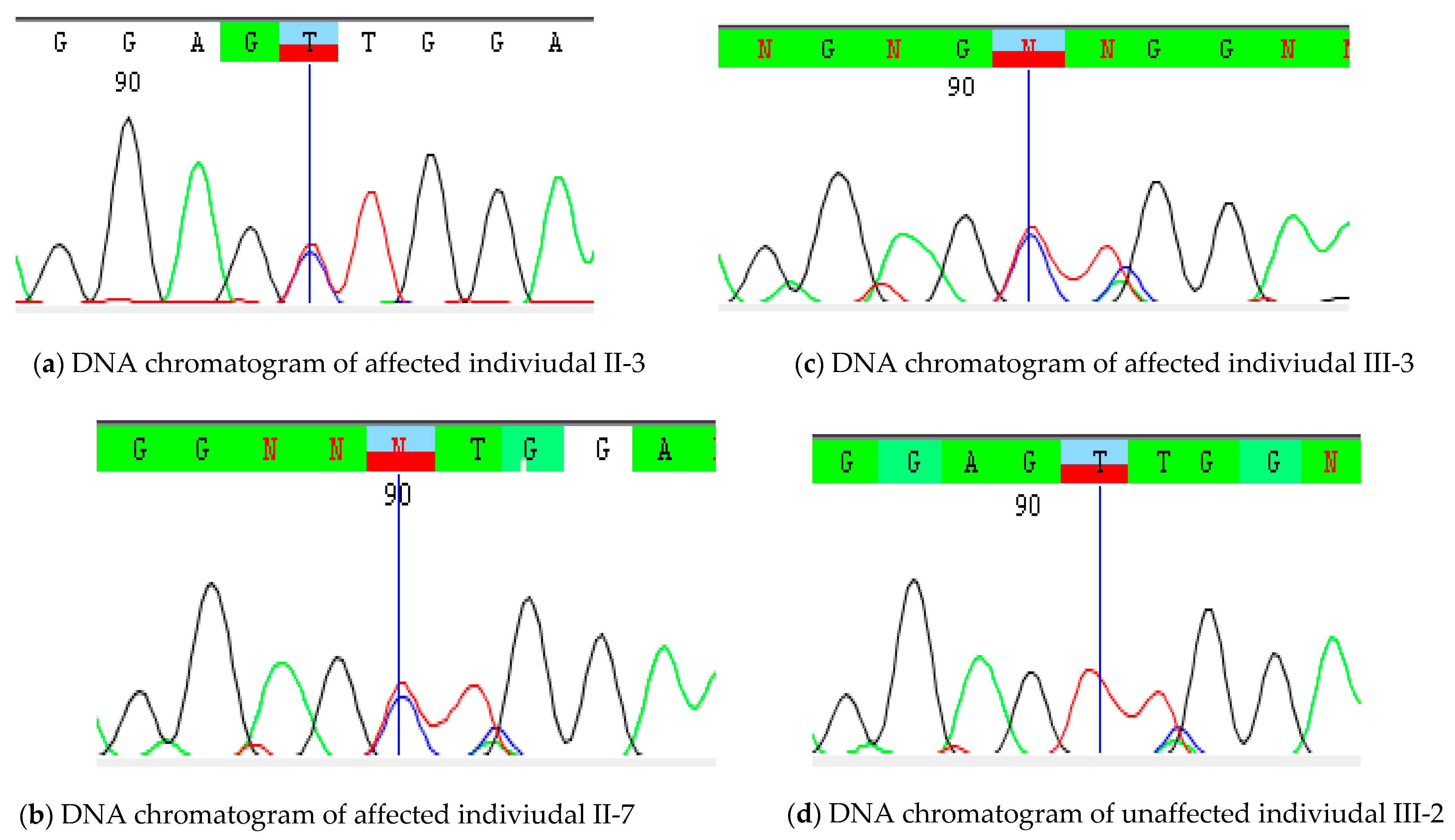 Exome Sequencing Identifies a Novel FBN1 Variant in a Pakistani Family ...