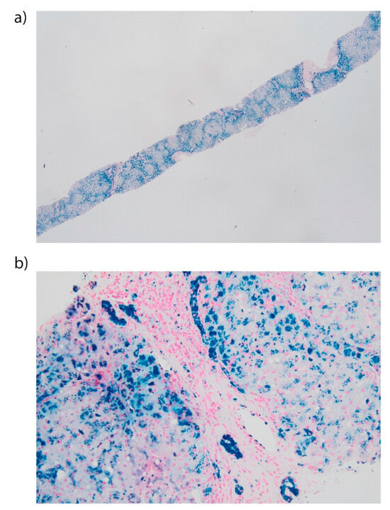 New Mutations in HFE2 and TFR2 Genes Causing Non HFE-Related Hereditary ...