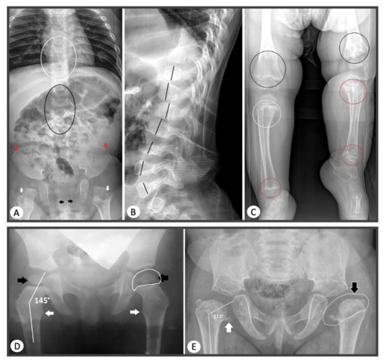Clinical and Genetic Characteristics of COL2A1-Associated Skeletal ...