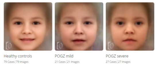 Genotype-Phenotype Comparison in POGZ-Related Neurodevelopmental ...