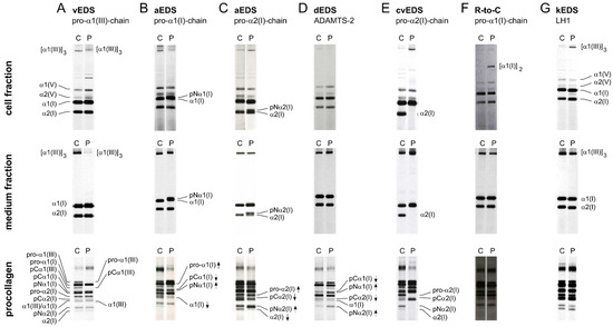 The Ehlers–Danlos Syndromes against the Backdrop of Inborn Errors of ...