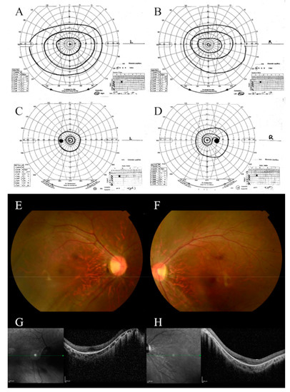 Maternal Uniparental Isodisomy of Chromosome 4 and 8 in Patients with ...
