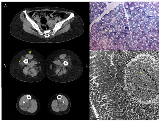 Central Core Disease: Facial Weakness Differentiating Biallelic from ...