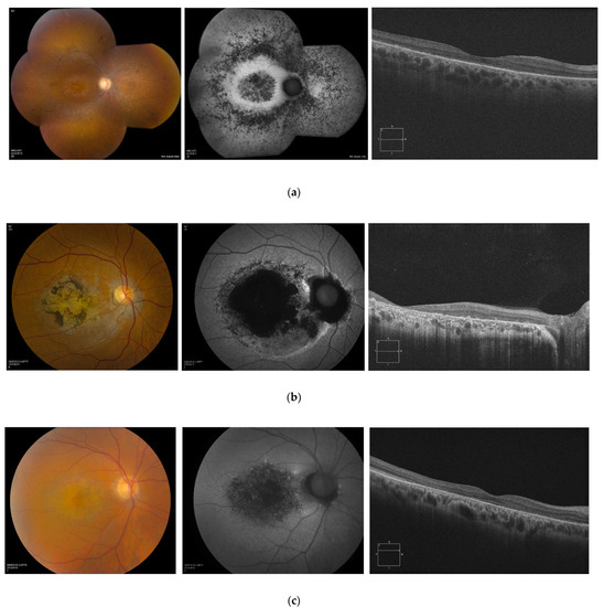 Clinical Phenotypes of CDHR1-Associated Retinal Dystrophies