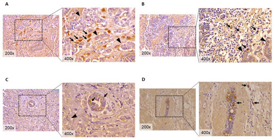 Cellular Senescence in Normal Mammary Gland and Breast Cancer ...