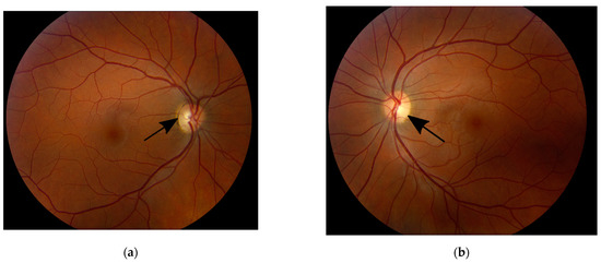 Biallelic Optic Atrophy 1 (OPA1) Related Disorder—Case Report and ...