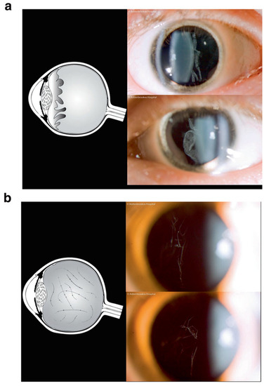 Dominant Stickler Syndrome