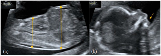 Prenatal Diagnosis of Jeune Syndrome Caused by Compound Heterozygous ...
