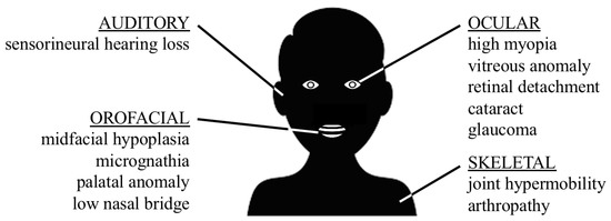 Hearing Loss in Stickler Syndrome: An Update