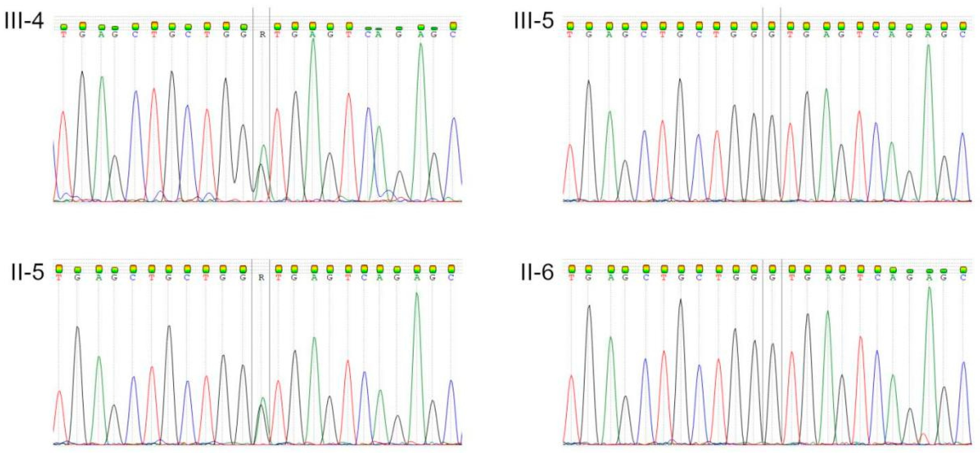 A Splice Variant of the MYH7 Gene Is Causative in a Family with ...