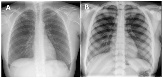 Spectrum of Skeletal Imaging Features in Osteopetrosis: Inheritance ...