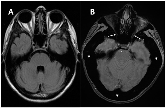 Spectrum of Skeletal Imaging Features in Osteopetrosis: Inheritance ...