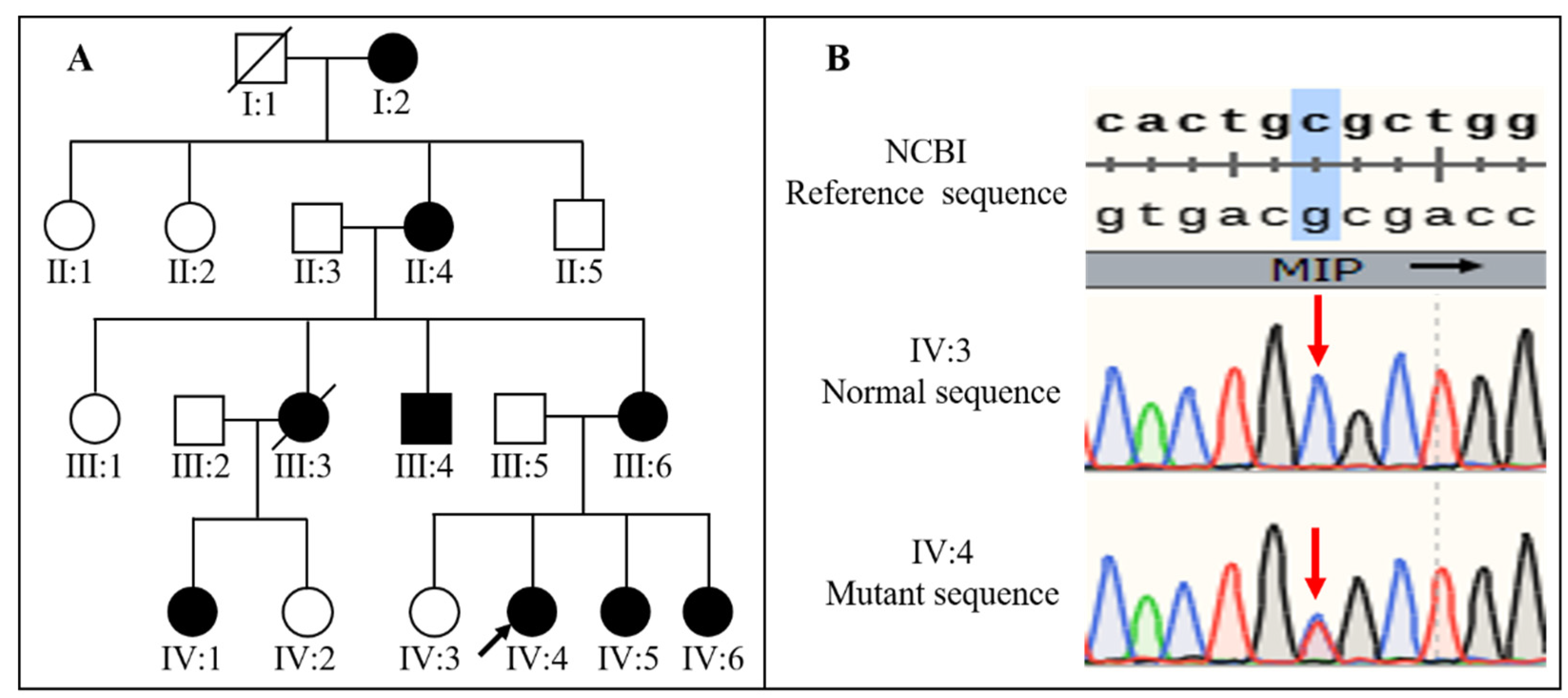 Anterior Umbilication of Lens in a Family with Congenital Cataracts Associated with a Missense ...