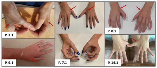 Genetic and Clinical Spectrum of GNE Myopathy in Russia