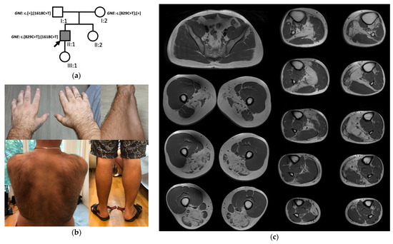 Genetic and Clinical Spectrum of GNE Myopathy in Russia