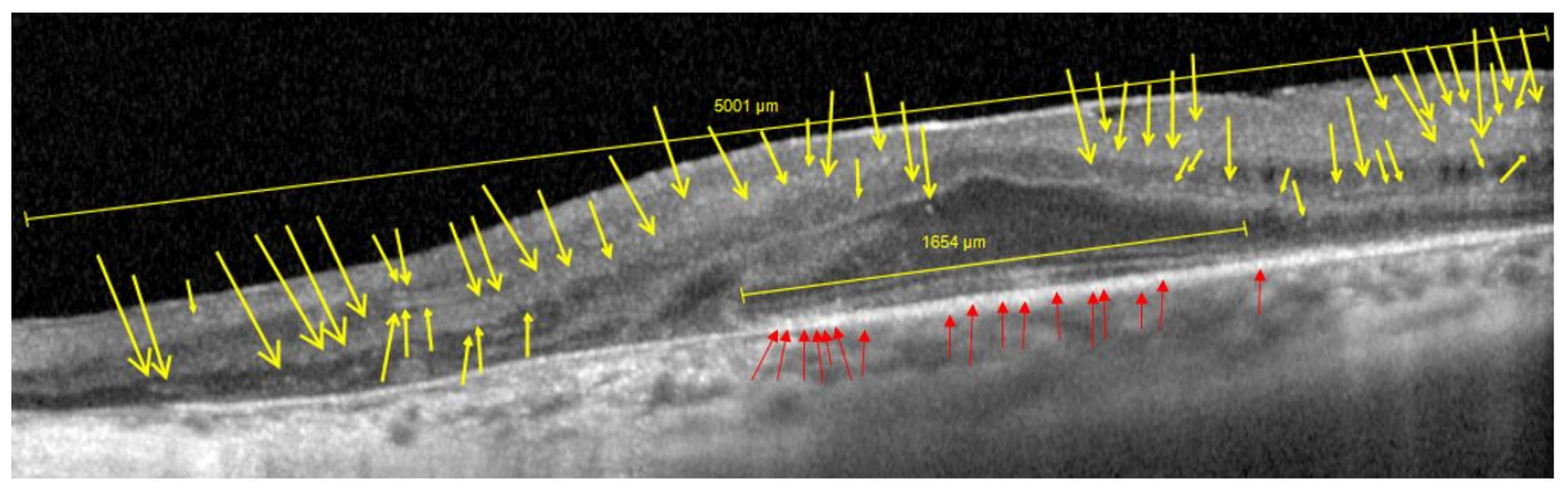 The Presence of Hyperreflective Foci Reflects Vascular, Morphologic and ...