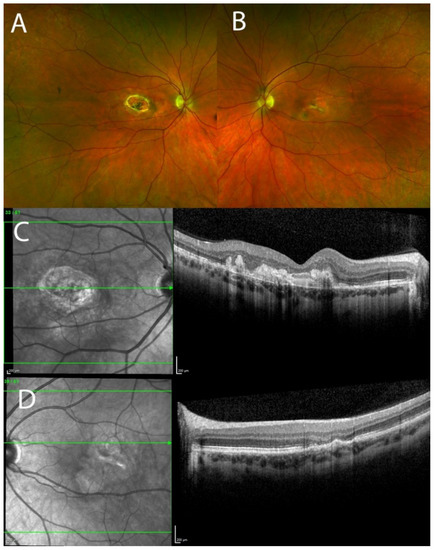 Genes | Free Full-Text | Potential CRISPR Base Editing Therapeutic ...