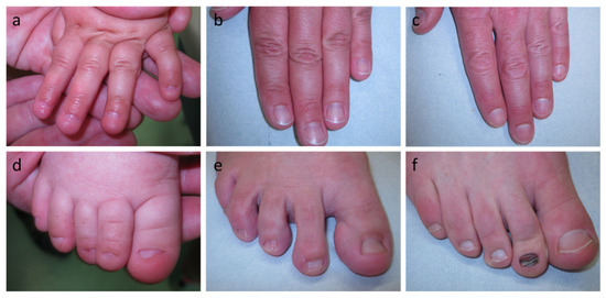 Congenital Nail Disorders among Children with Suspected Ectodermal ...
