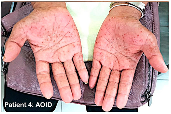 Loss of Function TGFBR2 Variant as a Contributing Factor in Generalized ...