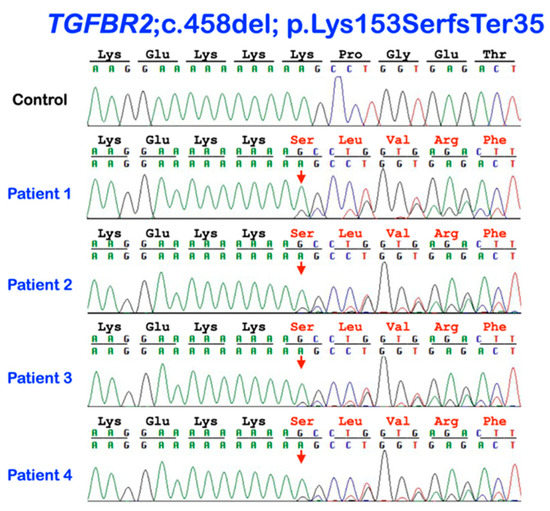 Loss of Function TGFBR2 Variant as a Contributing Factor in Generalized ...