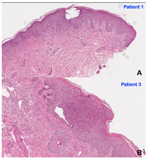 Loss of Function TGFBR2 Variant as a Contributing Factor in Generalized ...