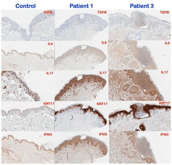 Loss of Function TGFBR2 Variant as a Contributing Factor in Generalized ...