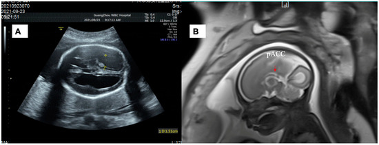 Genes | Free Full-Text | Prenatal Diagnosis of PPP2R1A-Related ... Genes | Free Full-Text | Prenatal Diagnosis of PPP2R1A-Related ...