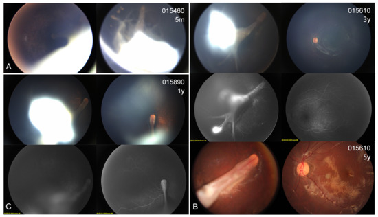 Phenotype-Based Genetic Analysis Reveals Missing Heritability of KIF11 ...