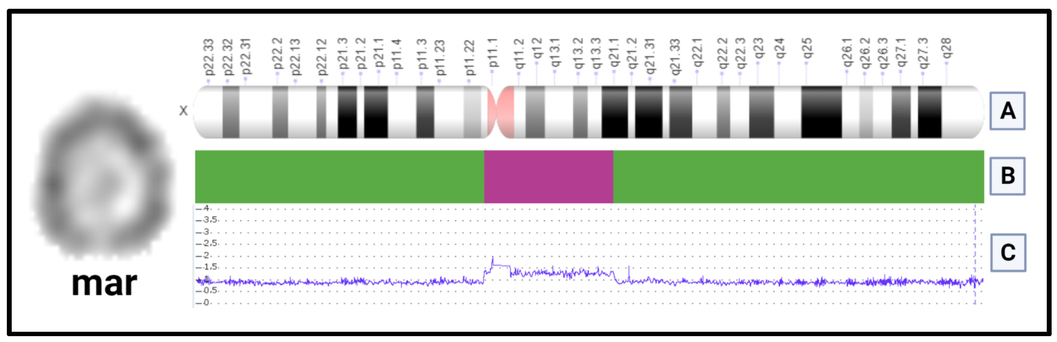 Identification of a Small Supernumerary Marker Chromosome in a Turner ...