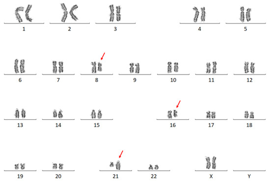 Fusion Gene-Based Classification of Variant Cytogenetic Rearrangements ...