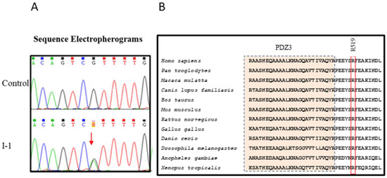 A Novel DLG1 Variant in a Family with Brugada Syndrome: Clinical ...