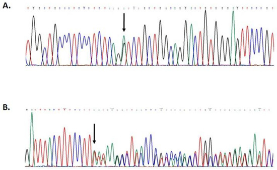 Hereditary Cancer Syndrome in a Family with Double Mutation in BRIP1 ...