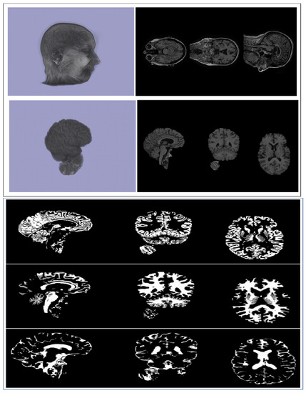 Deep Learning-Based Feature Extraction with MRI Data in Neuroimaging Genetics for Alzheimer’s ...