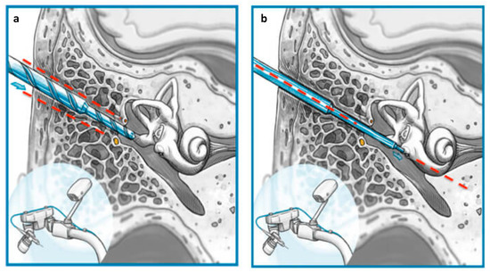 Evaluation of a Less Invasive Cochlear Implant Surgery in OPA1 ...