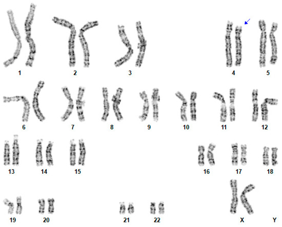 Patau Syndrome Karyotype