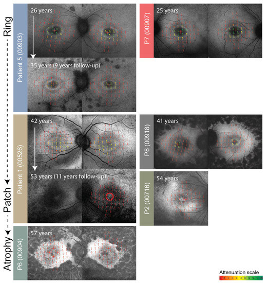 Natural Disease Course in Usher Syndrome Patients Harboring USH2A ...