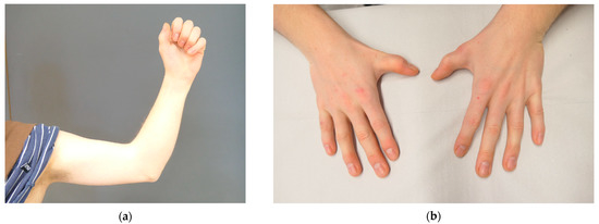 FGF9-Associated Multiple Synostoses Syndrome Type 3 in a ...