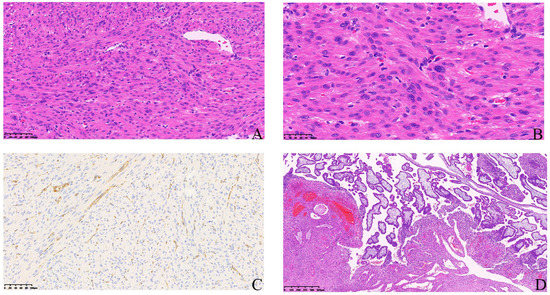 A Missense Mutation c.1132G > A in Fumarate Hydratase (FH) Leads to ...