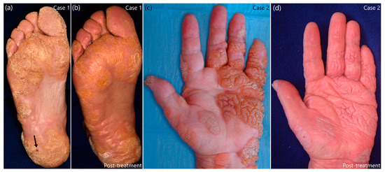 RETRACTED: Systemic Retinoids for Generalized Verrucosis Due to ...