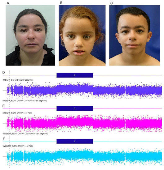 Rare 15q21.1q22.31 Duplication Due to a Familial Chromosomal Insertion ...