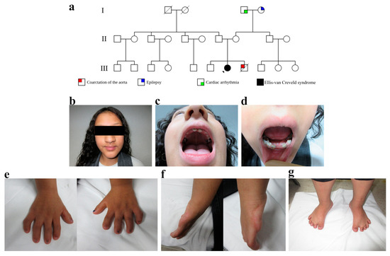 Identification of Compound Heterozygous EVC2 Gene Variants in Two ...