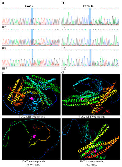 Identification of Compound Heterozygous EVC2 Gene Variants in Two ...