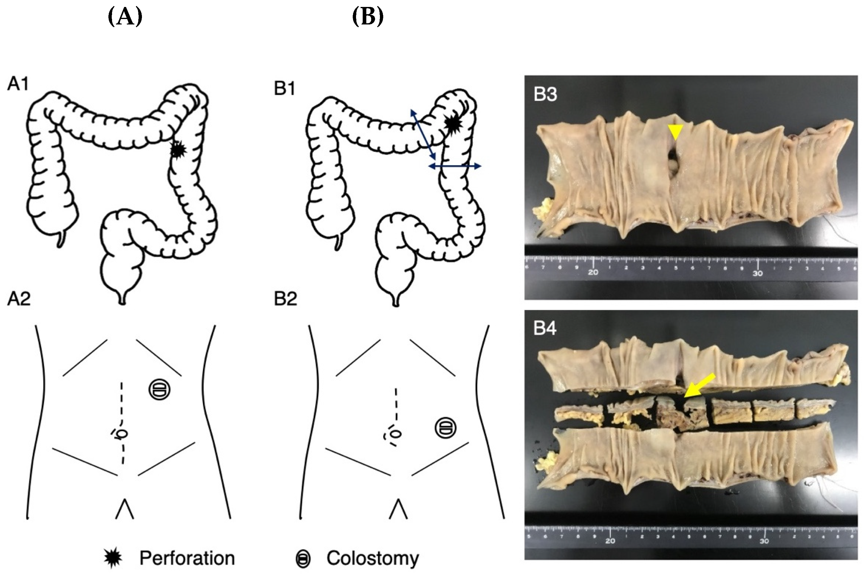 Detailed Courses and Pathological Findings of Colonic Perforation ...