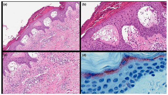 Netherton Syndrome Caused by Heterozygous Frameshift Mutation Combined ...