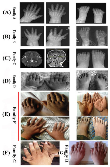 Biallelic Variants in Seven Different Genes Associated with Clinically ...