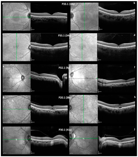 Molecular and Clinical Characterization of CNGA3 and CNGB3 Genes in ...