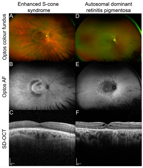 Nuclear Receptor Subfamily 2 Group E Member 3 (NR2E3): Role in Retinal ...